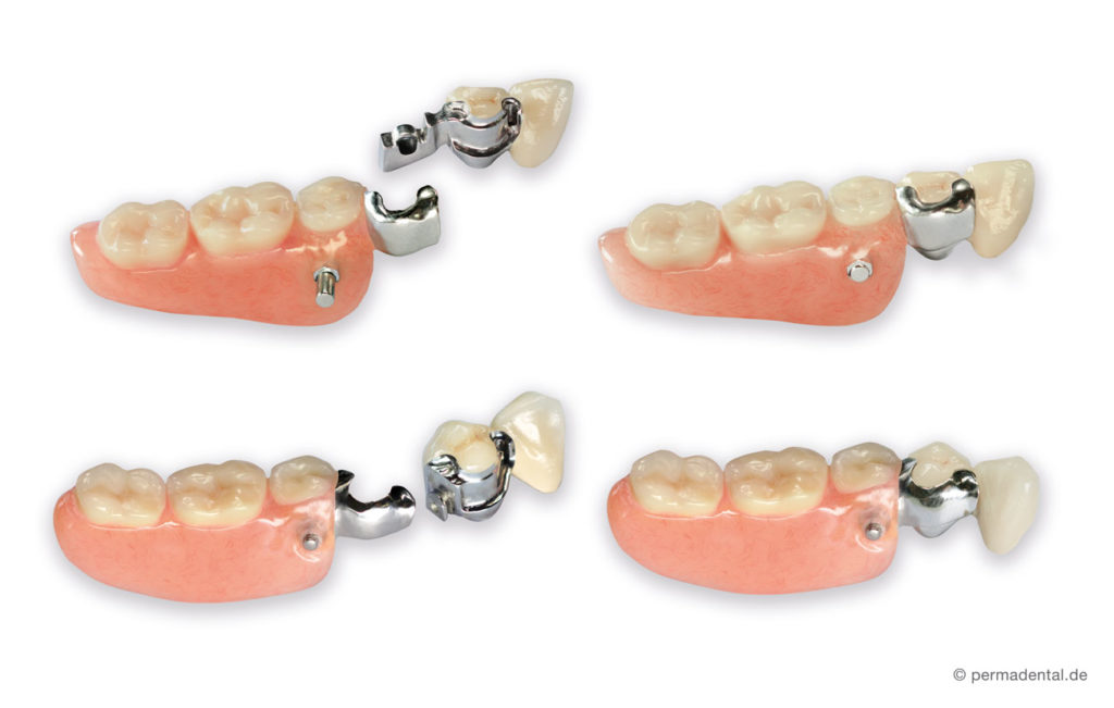 Prothese – dental:spiegel